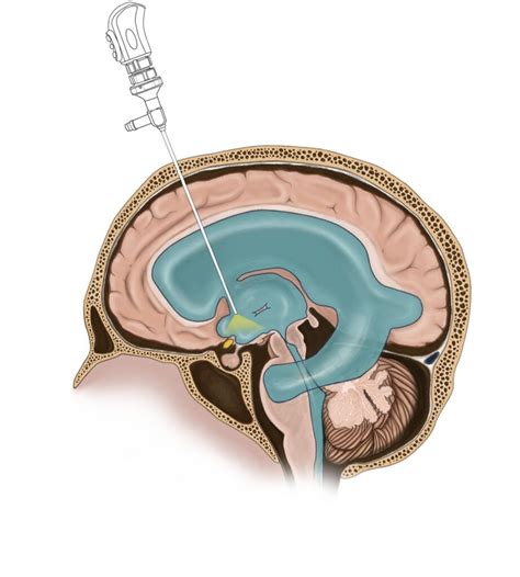 Understanding Normal Pressure Hydrocephalustreatment Options Pacific