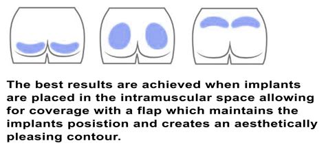 Buttock Augmentation Cosmetic Surgery Holidays In Malaysia And Thailand Beauty Yours