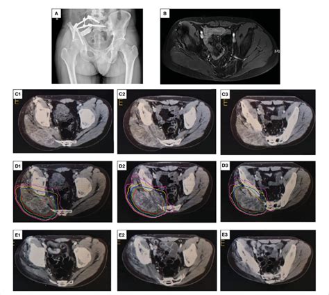 X Ray Contrast Enhanced CT And Radiation Dose Segmentation Diagram Download Scientific