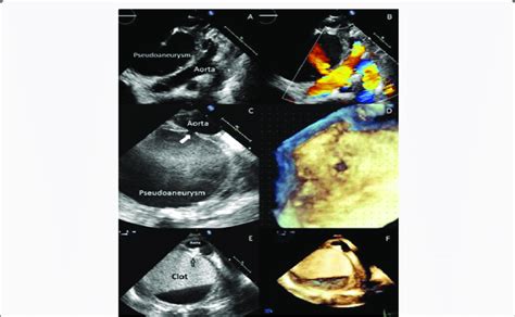 A F 2d Transthoracic Echocardiography A And B Suprasternal View Download Scientific Diagram