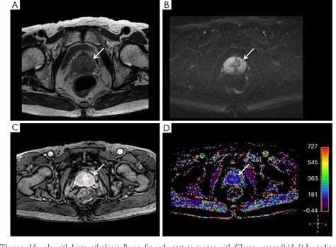 Dynamic Contrast Enhanced Magnetic Resonance Imaging For Risk Stratification In Patients With