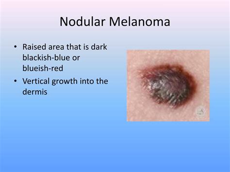 Nodular Melanoma Pictures Symptoms Prognosis