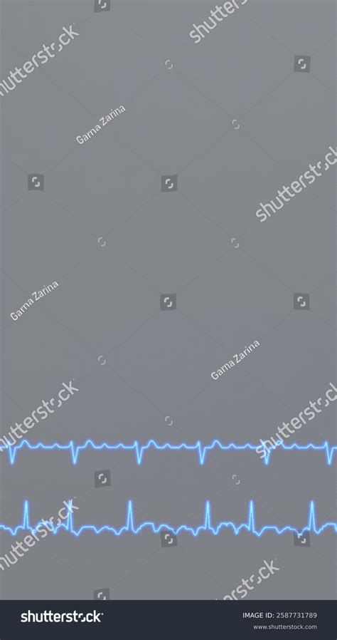 Ecg Graphs Regular Irregular Atrial Flutter Stock Illustration