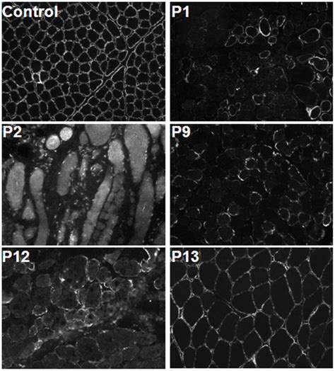 Skeletal Muscle Cryo Sections From Control And Dystroglycanopathy