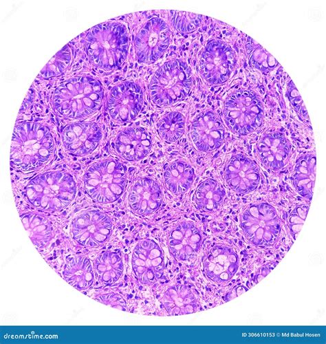 Ileo Cecal Ulcer Biopsy Chronic Nonspecific Ileitis With Ulcer Section Show Ileal Mucosa