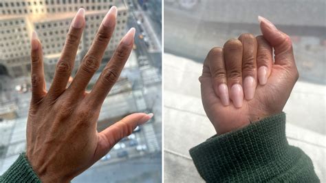 Dermatillomania Recovery
