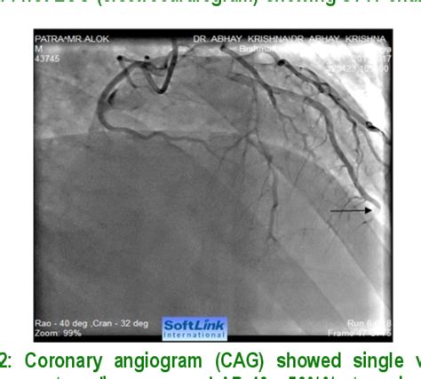 Figure 2 From Non ST Elevation Myocardial Infarction NSTEMI A Case Study Semantic Scholar