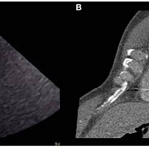 A Contrast Echocardiography Showing Left Ventricular Non Compaction Download Scientific