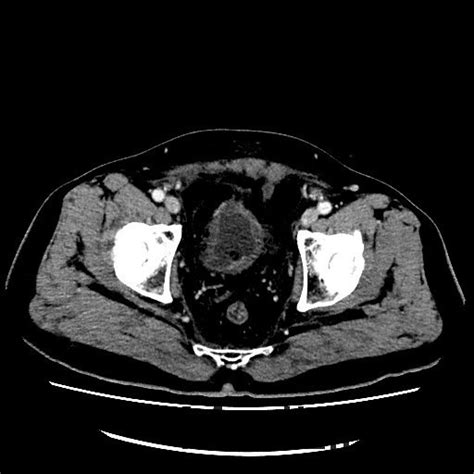 确诊前列腺癌一例！ 医联