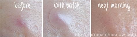 Review COSRX Acne Pimple Master Patch Berries In The Snow