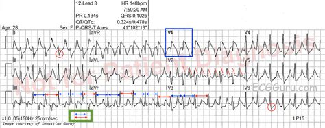 Tachycardia In An Unresponsive Patient Ecg Guru Instructor Resources