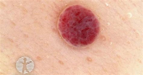 Dermoscopy Red Globular Pattern Image