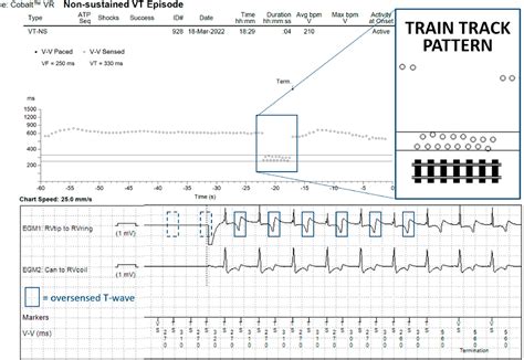 Figure 1 From T Wave Oversensing With Contemporary Implantable Cardioverter Defibrillators