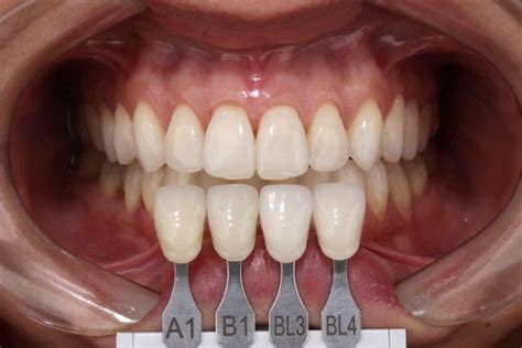 Supervised At Home Whitening With 10 Hydrogen Peroxide Fgm Dental Group