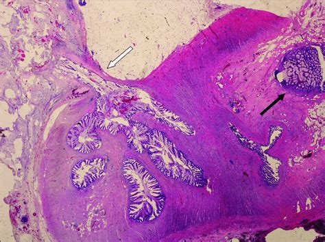 Histopathology Of Ruptured Villous Appendiceal Mucocele Right Handed Download Scientific