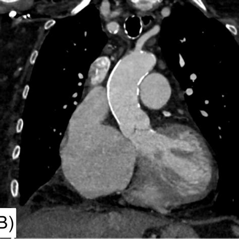 Preoperative Cta Demonstrating Diffuse Circumferential Calcification Download Scientific