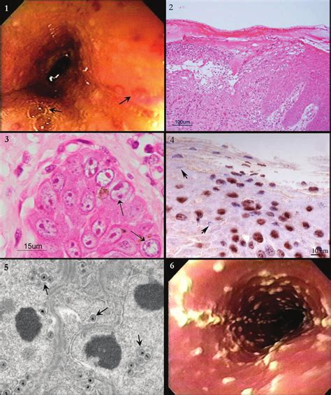 Endoscopic View Of Punctate Esophageal Ulcers Arrows In A 1 Month Old Download Scientific