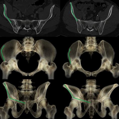 Examples Of Pelves With And Without Sacral Dysmorphism Note The Download Scientific Diagram