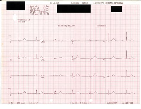 Figure 3 From Prevalence And Significance Of An Isolated Long Qt Interval In Elite Athletes