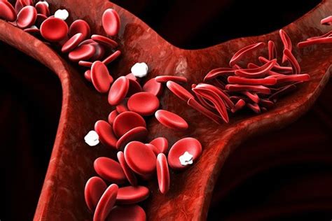 Cooleys Anemia Or Thalassemia Major