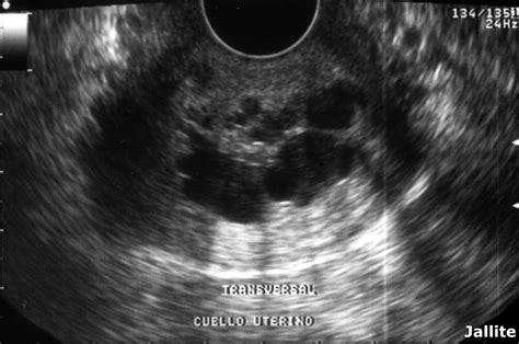 Cervicitis Cronica