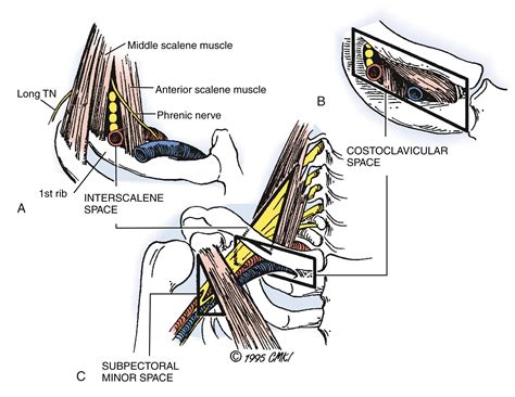 Definition Of Thoracic Outlet Compression Syndrome At Erna Davila Blog