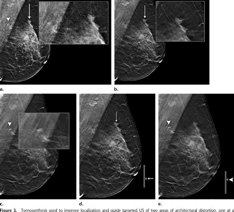 Figure 3 From Tomosynthesis Detected Architectural Distortion Management Algorithm With