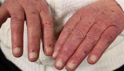 Bacterial Endocarditis Oslers Nodes And Janeways Lesions