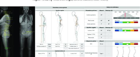 eos ® imaging example showing spine parameters and their relationship