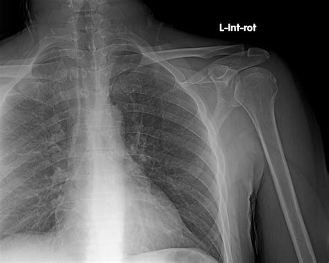 Shoulder Subluxation X Ray