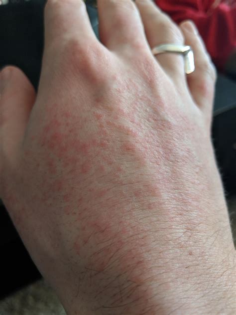 Skin Rash On Hands And Wrists What Is This Rash On My Wrist Dfwnri