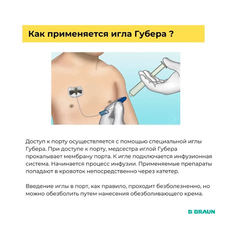 Иглы Surecan c крыльями без Y-коннектора 22G (20 мм) купить в СПб