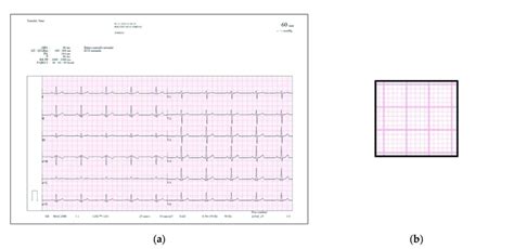 Graph Paper With Another Format Used For Reproducibility Normal Sinus Download Scientific
