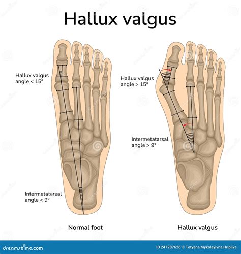 Hallux Valgus Orthopedic Support Vector Illustration 120302002