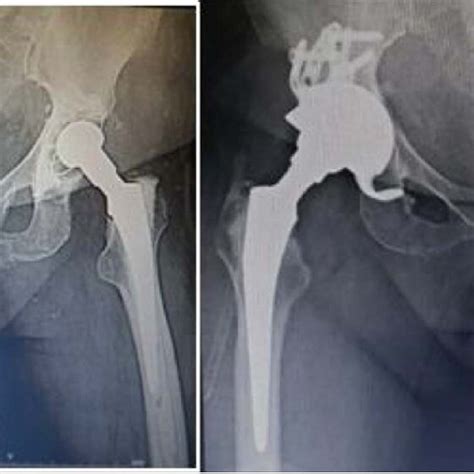 A Preoperative X Ray For A Case With Hip Spacer And Acetabular Download Scientific Diagram