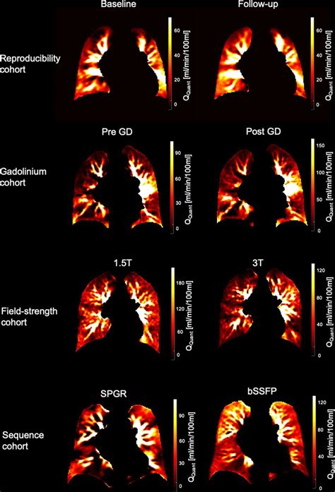 Representative Quantified Perfusion Maps From Each Cohort In The