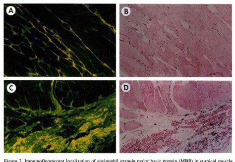 Figure 2 From Myiasis Due To Hypoderma Lineatum Infection Mimicking The Hypereosinophilic