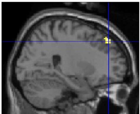 Figure 1 From Abnormalities Of Intrinsic Functional Connectivity In Autism Spectrum Disorders