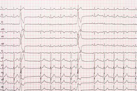 Acute Coronary Syndrome Acs Algorithm Acls Resources Acls