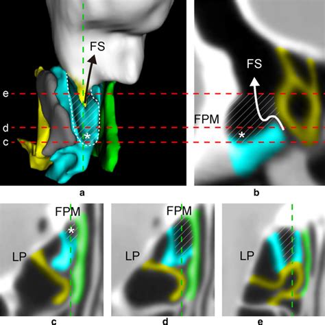 Anterior Ethmoid And Frontal Sinus Drainage Pathways Five Patterns