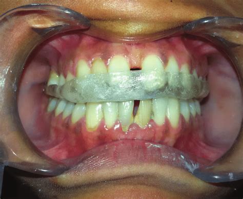 Centric Stabilizing Splint In Use Download Scientific Diagram