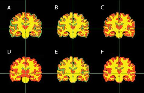 Segmentation Of Brain Using Various Priors With Segmentation Tool Fast Download Scientific