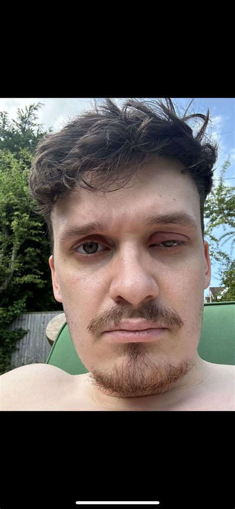 Periorbital Cellulitis Or Blepharitis Rblepharitis