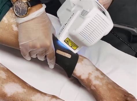 Vitiligo Skincare Treatment With Exciplex Light Therapy Este