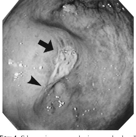 Figure 1 From Asymptomatic Amebic Colitis In A Homosexual Man