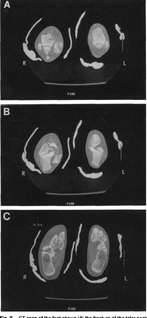 Figure 1 From Talar Neck Fracture With Talar Head Dislocation And Intact Ankle And Subtalar