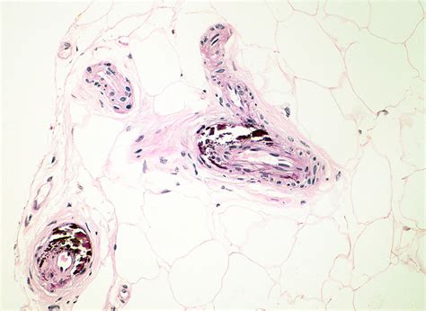Calciphylaxis Histology