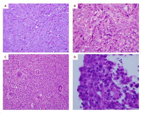 Figure 2 From Primary Urinary Bladder Angiosarcoma With Osteoclast Like Multinucleated Giant
