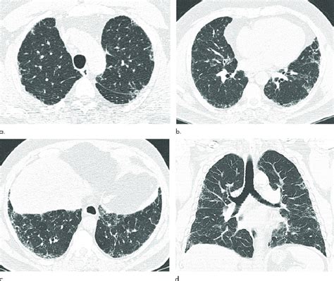 Probable Usual Interstitial Pneumonia Pattern A C Axial Inspiratory