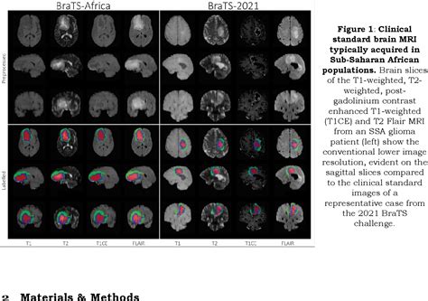The Brain Tumor Segmentation Challenge 2023 Glioma Segmentation In Sub